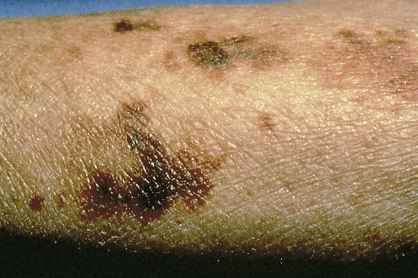 Home | Litt's Drug Eruption and Reaction Database